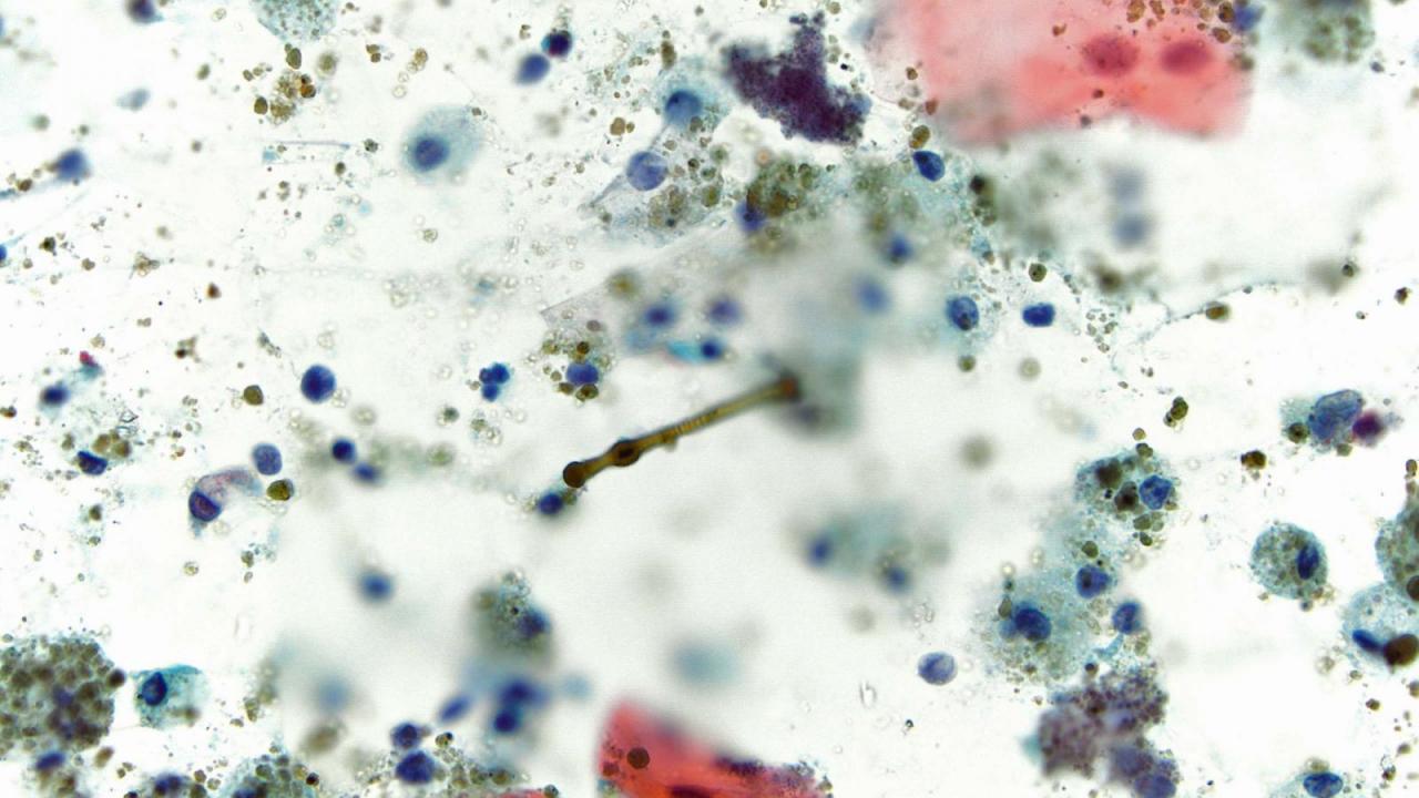 Pulmonary Pathology | Pathology