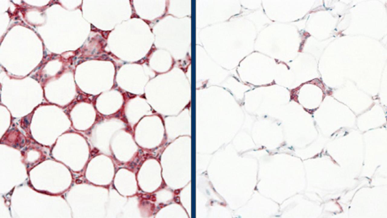 Belly Fat Promotes Diabetes Under Orders from Liver | Pathology