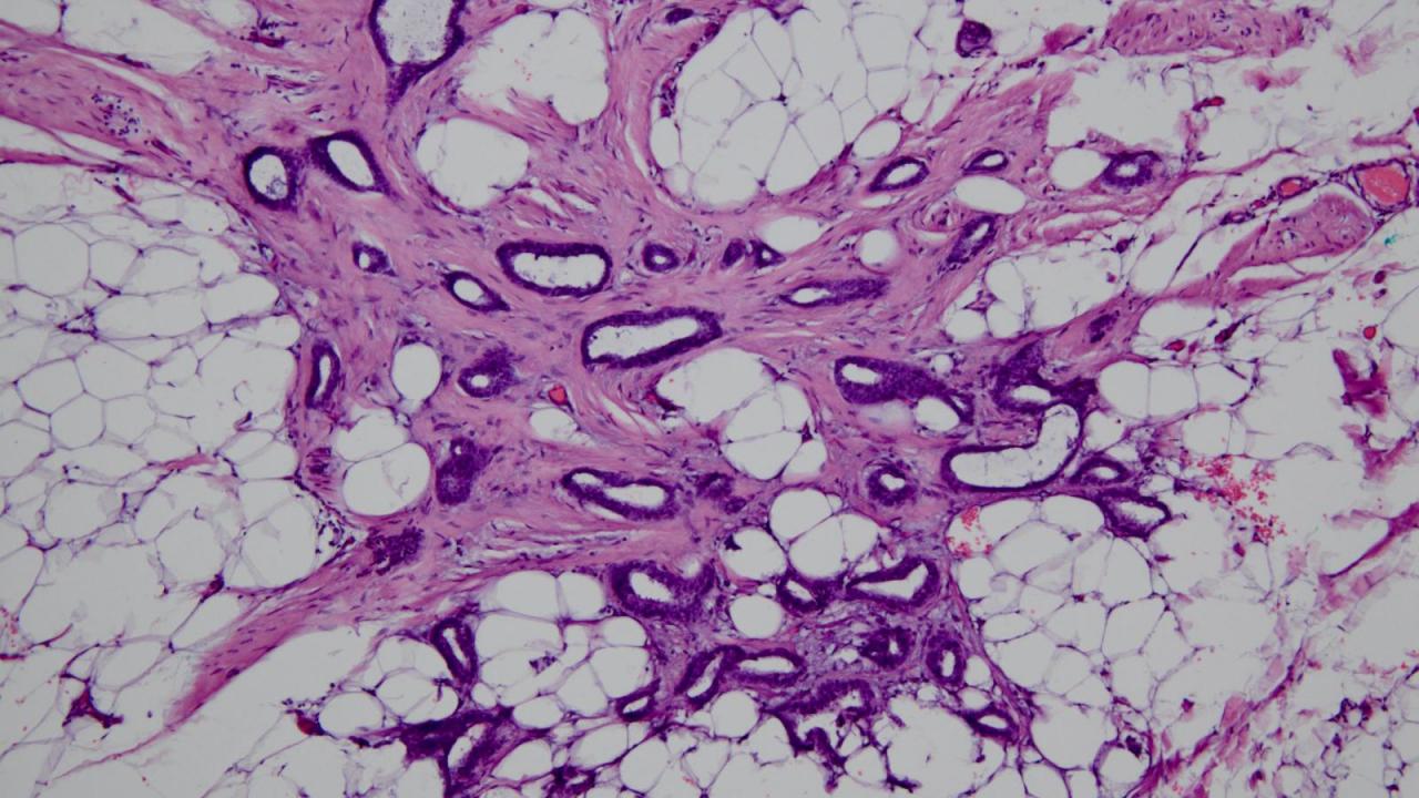 Breast Pathology | Pathology