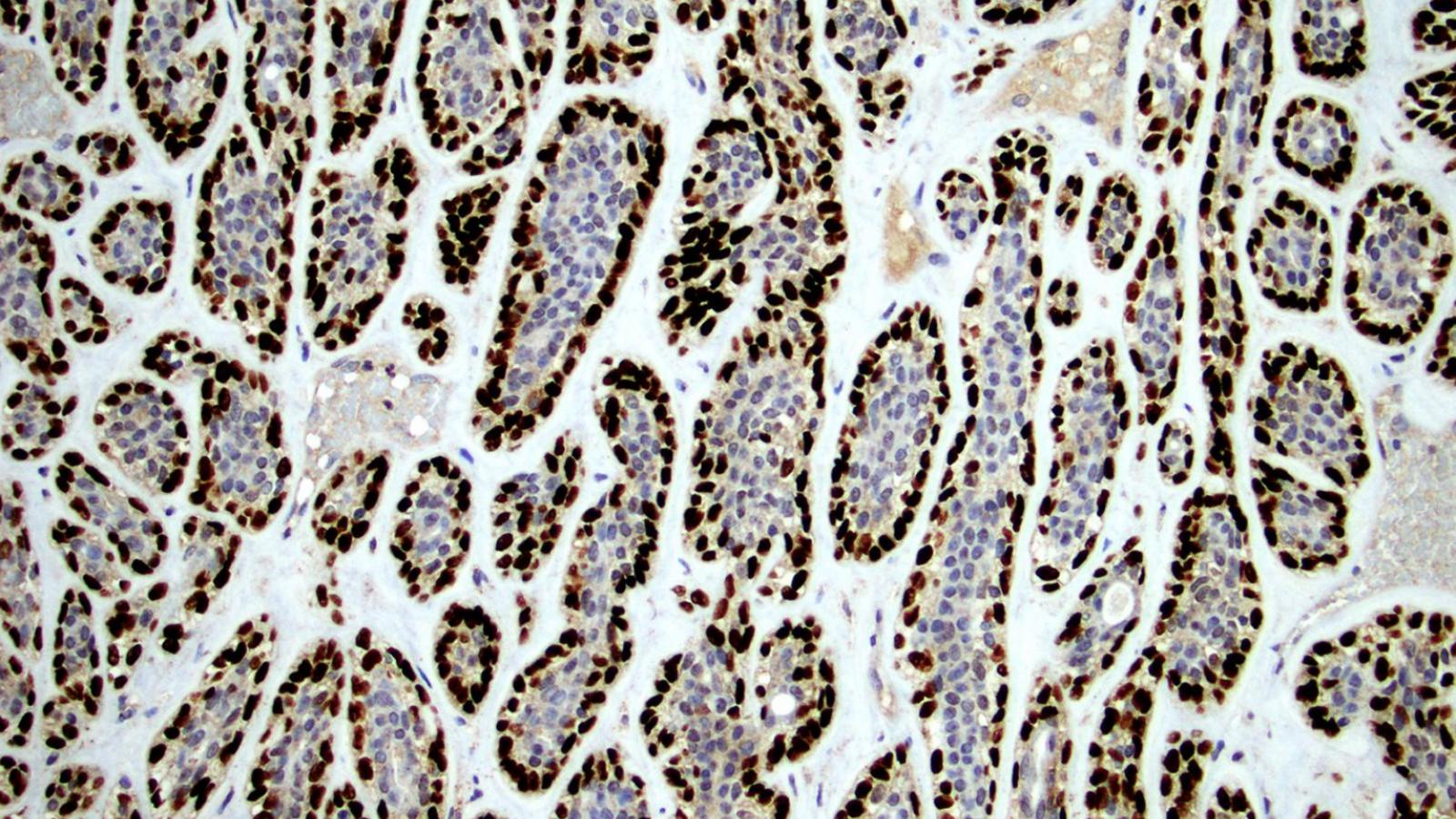 Head and Neck/Endocrine Pathology | Pathology