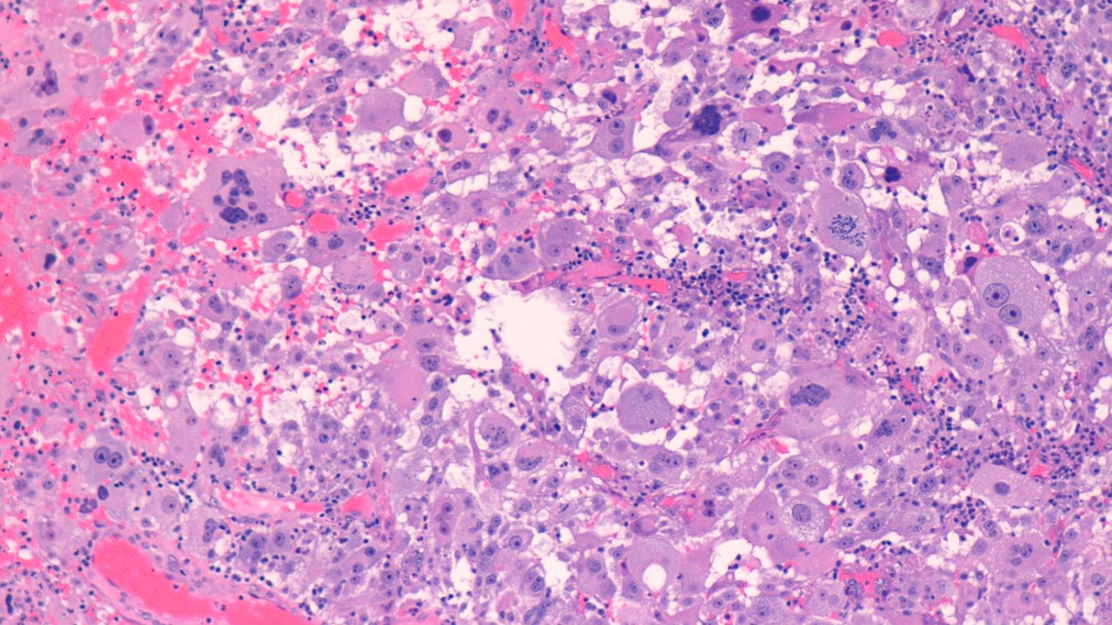 Neuropathology | Pathology