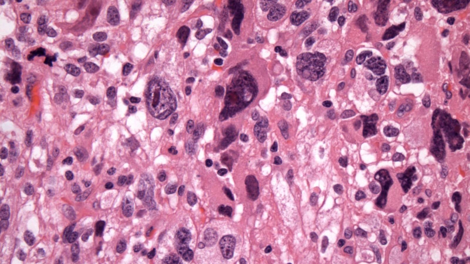 OB/GYN Pathology | Pathology