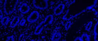 Targeted Myeloid Panel (TMP) | Pathology